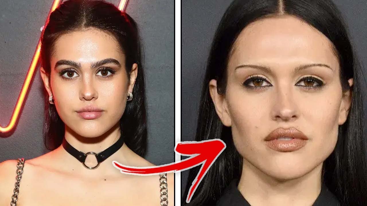 Botched Botox That Destroyed Celebrities Faces - YouTube