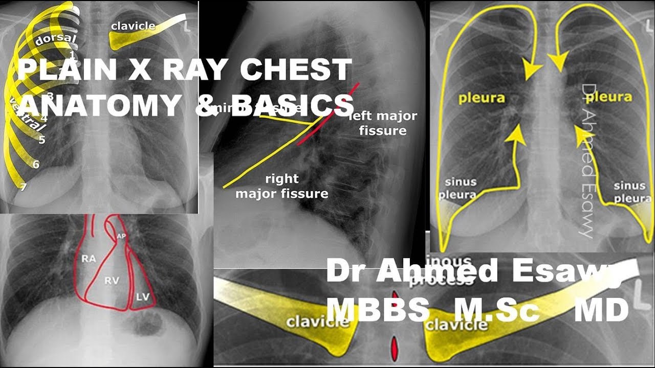 PLAIN X RAY CHEST ANATOMY & BASICS (VIDEOBOOK) - YouTube