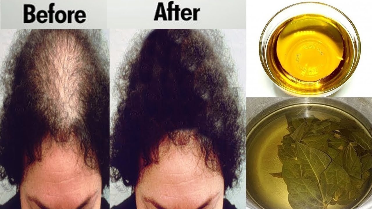 How to use castor oil to Stop Hair Fall | Hair Fall Solution | Natural ...