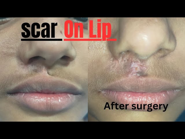 Lip Burn Scar Revision Surgery Uky - Infoupdate.org