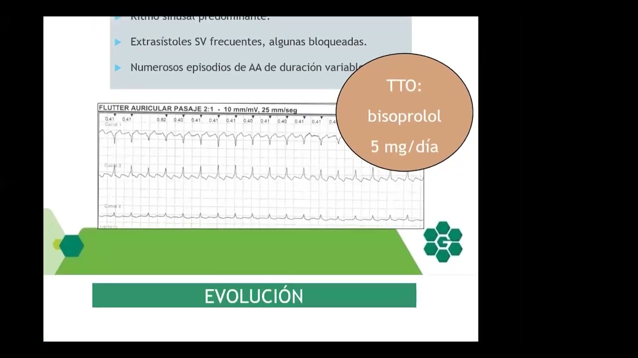 Aleteo Auricular. ¿Una arritmia inocente?. Ateneo Dpto. de Cardiología ...
