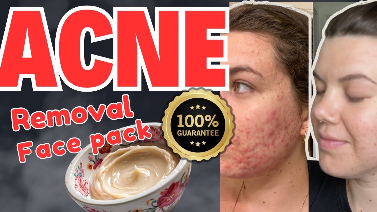 Acne removal Facepack | Home remedies for acne | Aztec Clay mask for ...