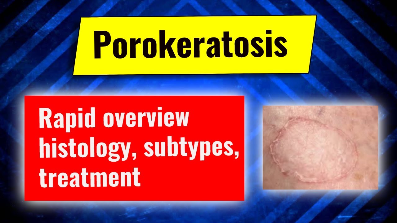Porokeratosis: overview, clinical subtypes, histology, treatment ...