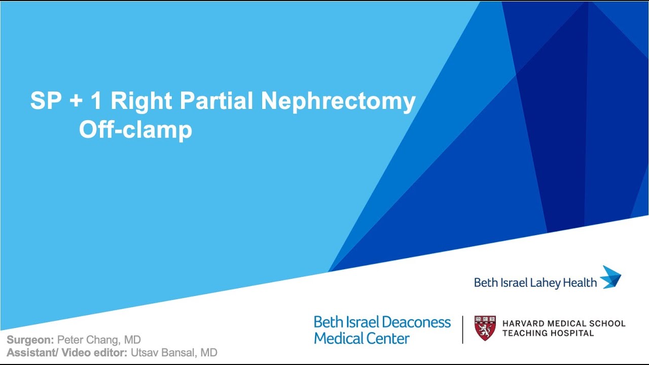 SP + 1 Right Partial Nephrectomy (Off-clamp) - YouTube