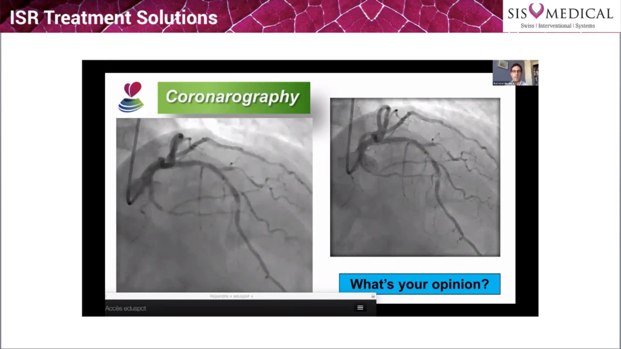 Webinar hosted by SIS Medical on OPN NC- Ultra High Pressure Plaque ...