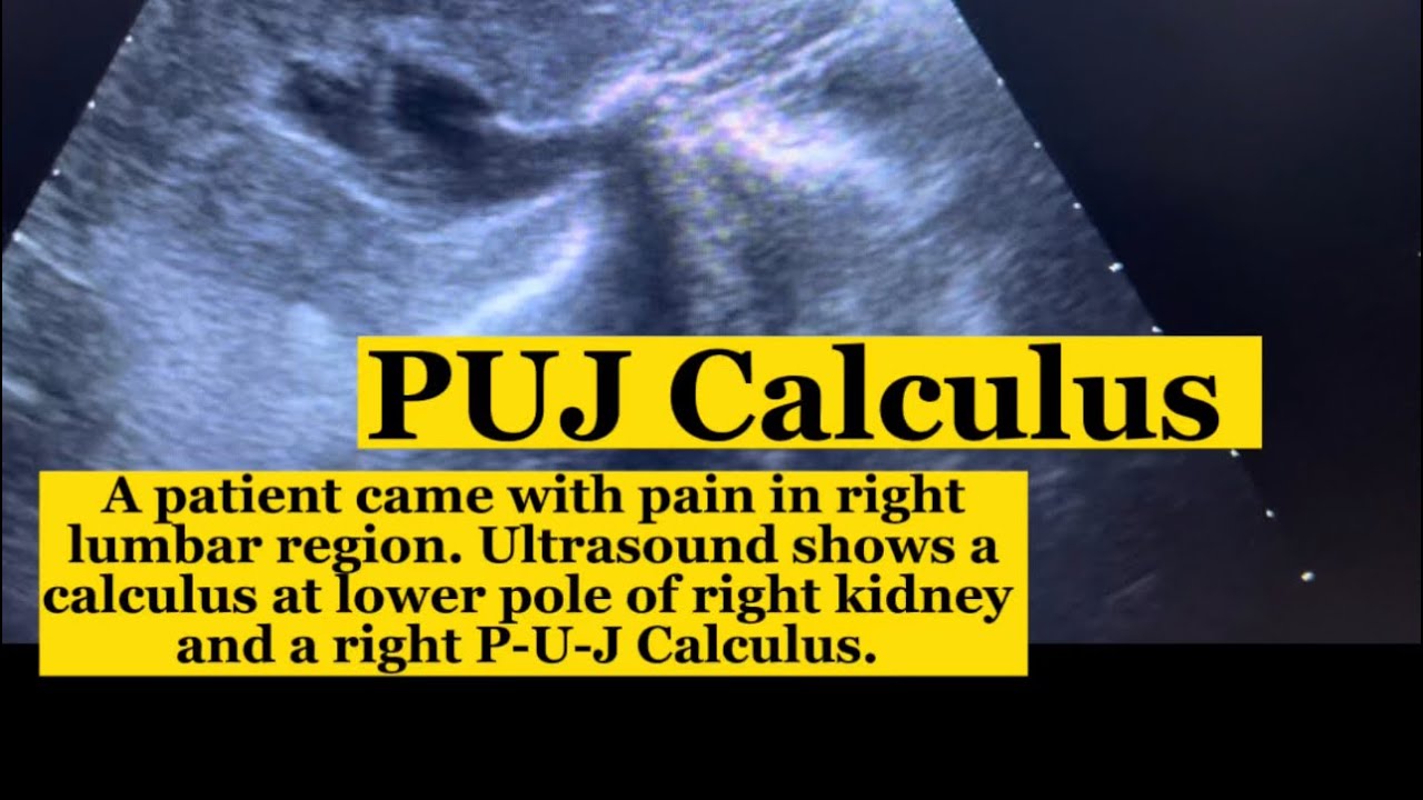 PUJ Calculus On Ultrasound | Case no 11 #ultrasoundscans #renalcalculi ...