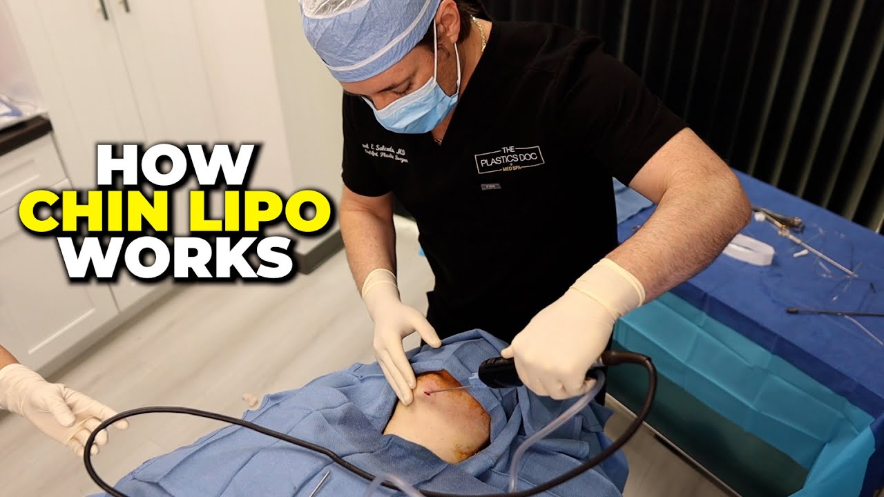How Chin Liposuction Works And Tools We Use - The Plastics Doc - YouTube
