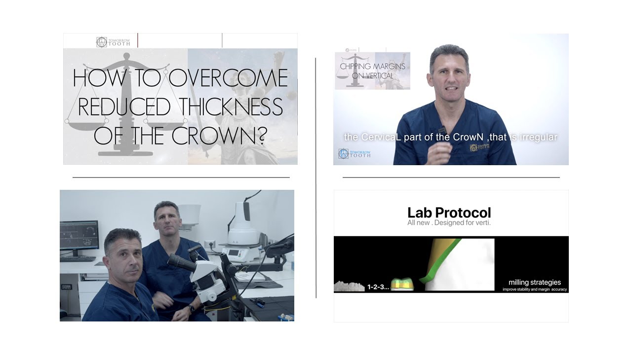 Preview How to Overcome Reduced Thickness of the Crown? Chipping Margins on Vertical + Lab ...