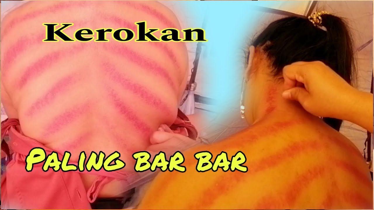 Full Kerokan Punggung Leher Hingga Bahu Sakit Di Jamin Sembuh Youtube