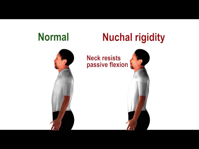 Nuchal Rigidity