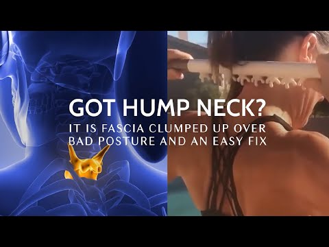 What Causes Hump Neck? Exploring Fascia and Posture - YouTube