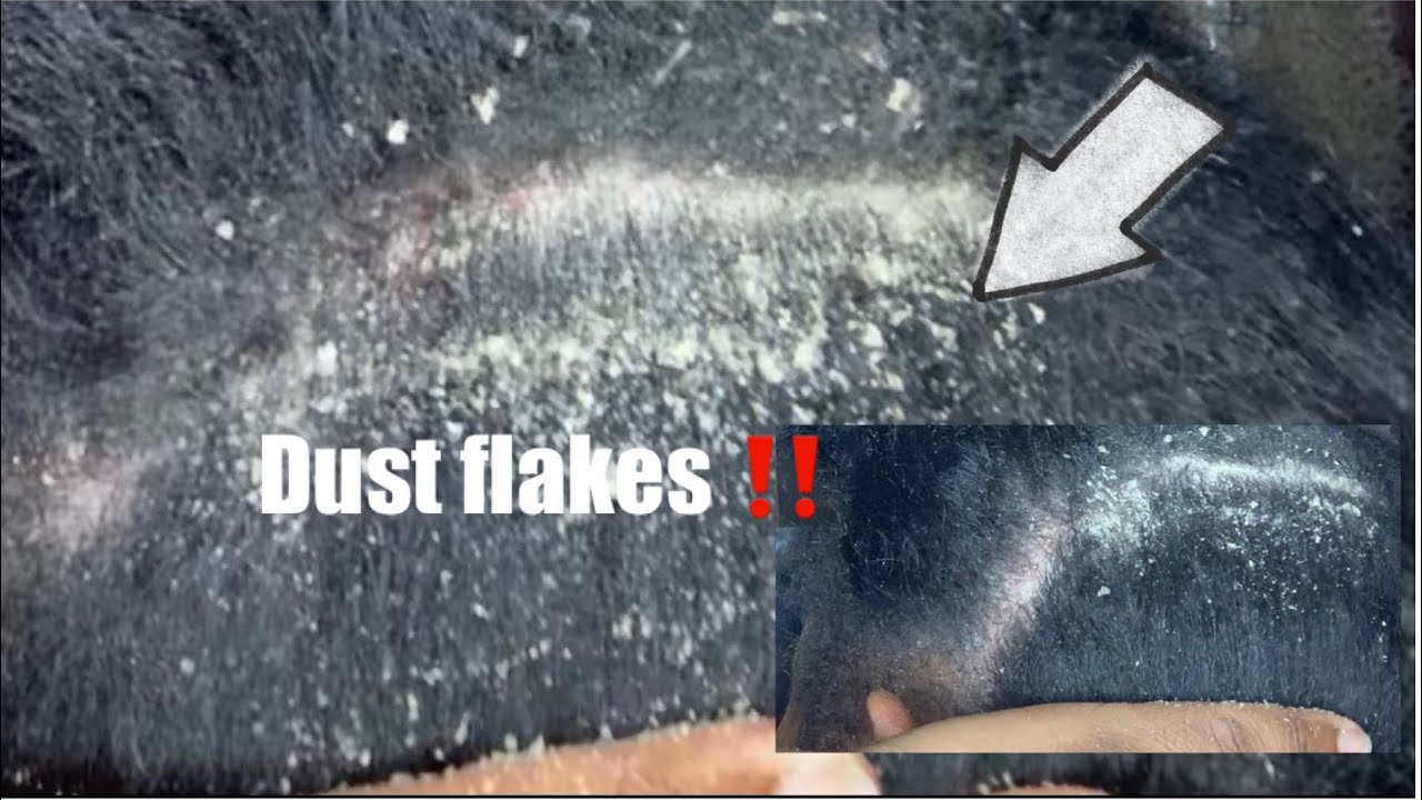 Crusty Flakes in the BACK🤔|| TOUGH FLAKES - YouTube