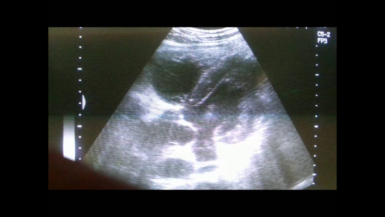 Left ventricle apical thrombus. - YouTube