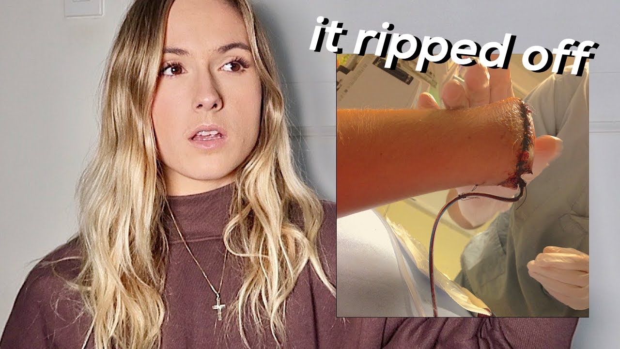 Did I Keep My Hand When It Ripped Off? // Amputee Q&A - YouTube