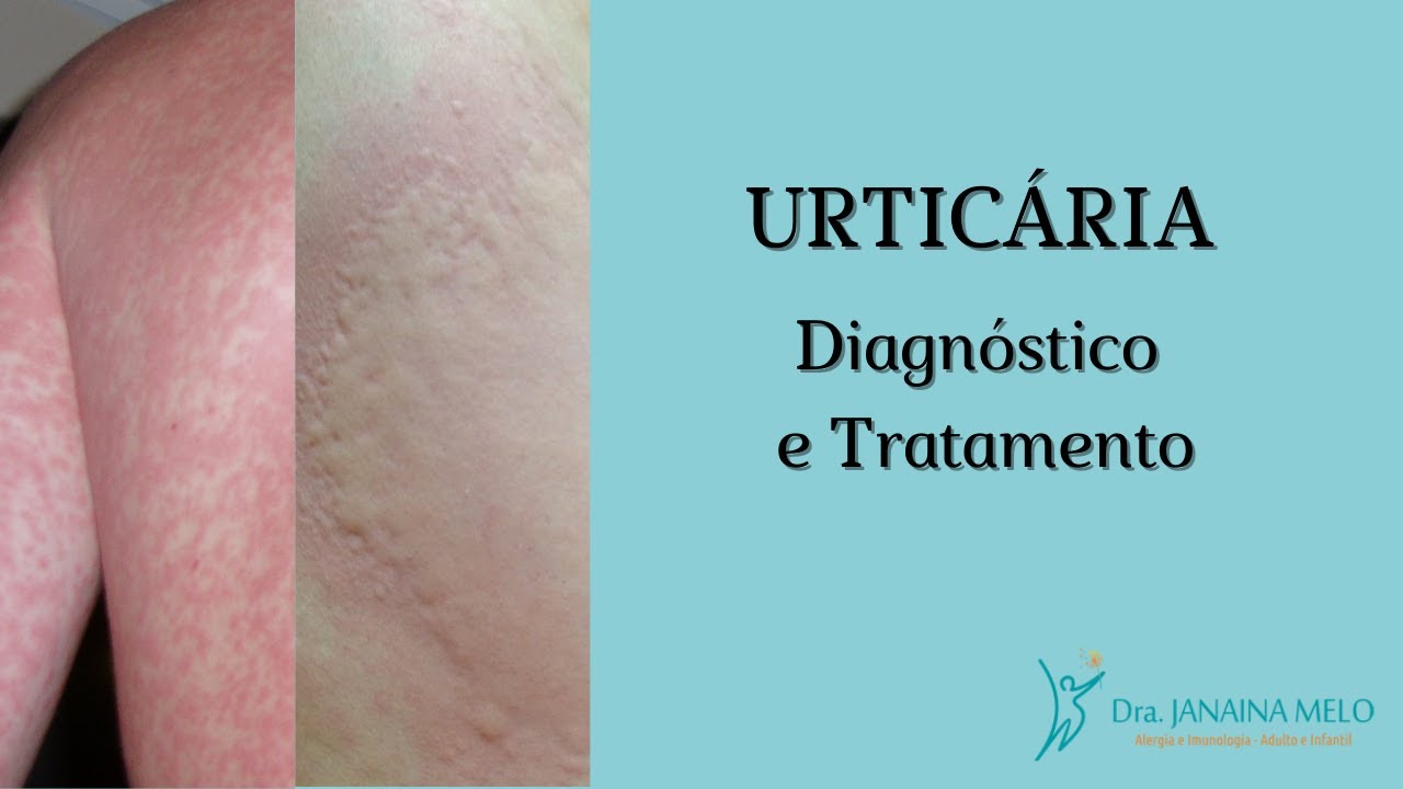 URTICÁRIA - Diagnóstico e Tratamento - YouTube