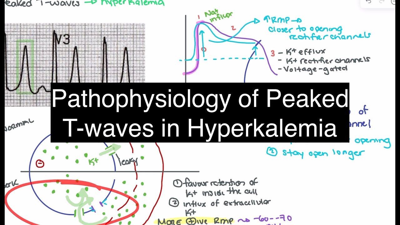 Hyperkalemia Explained: Pathophysiology of Peaked T-Waves - YouTube