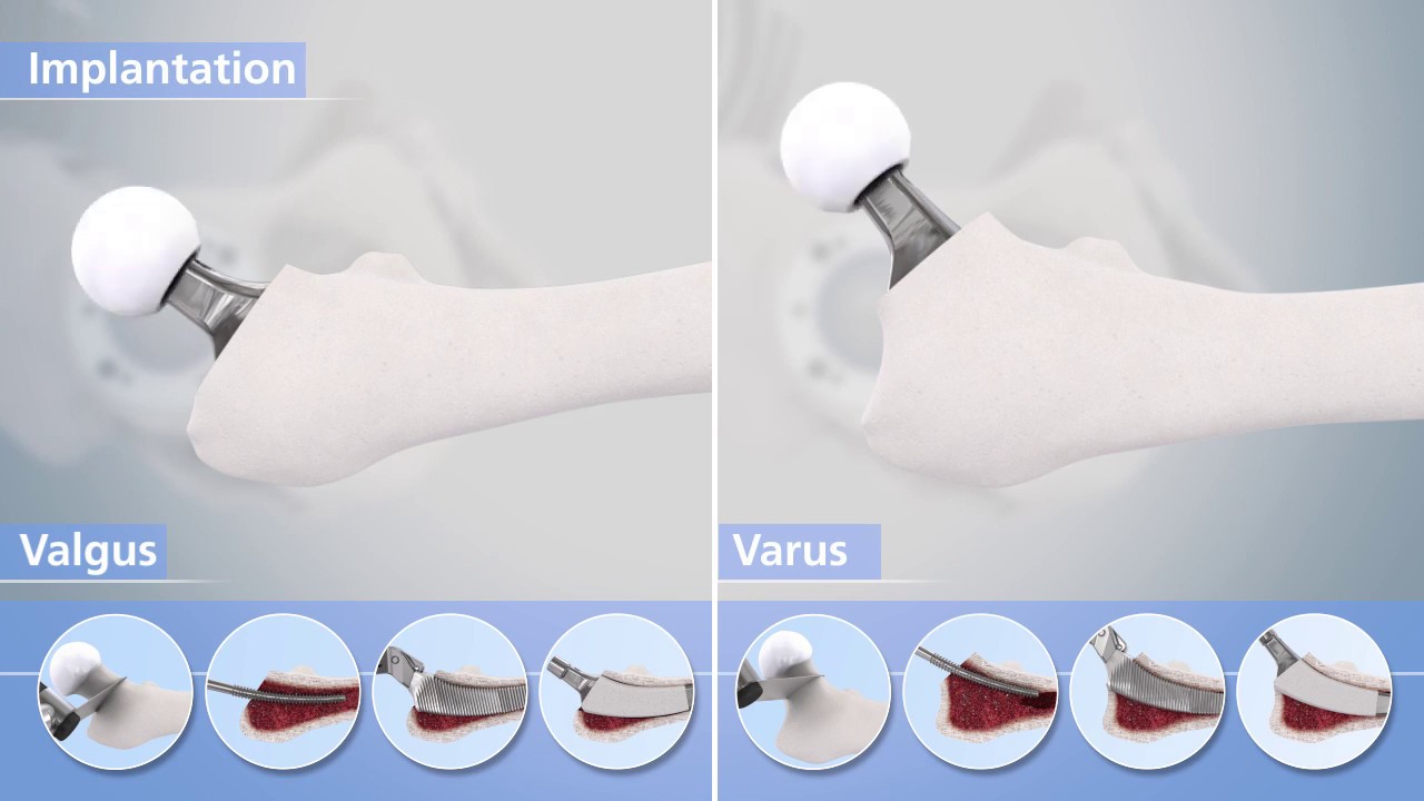 Mathys: Implantation des kalkargeführten optimys Schaftes - YouTube