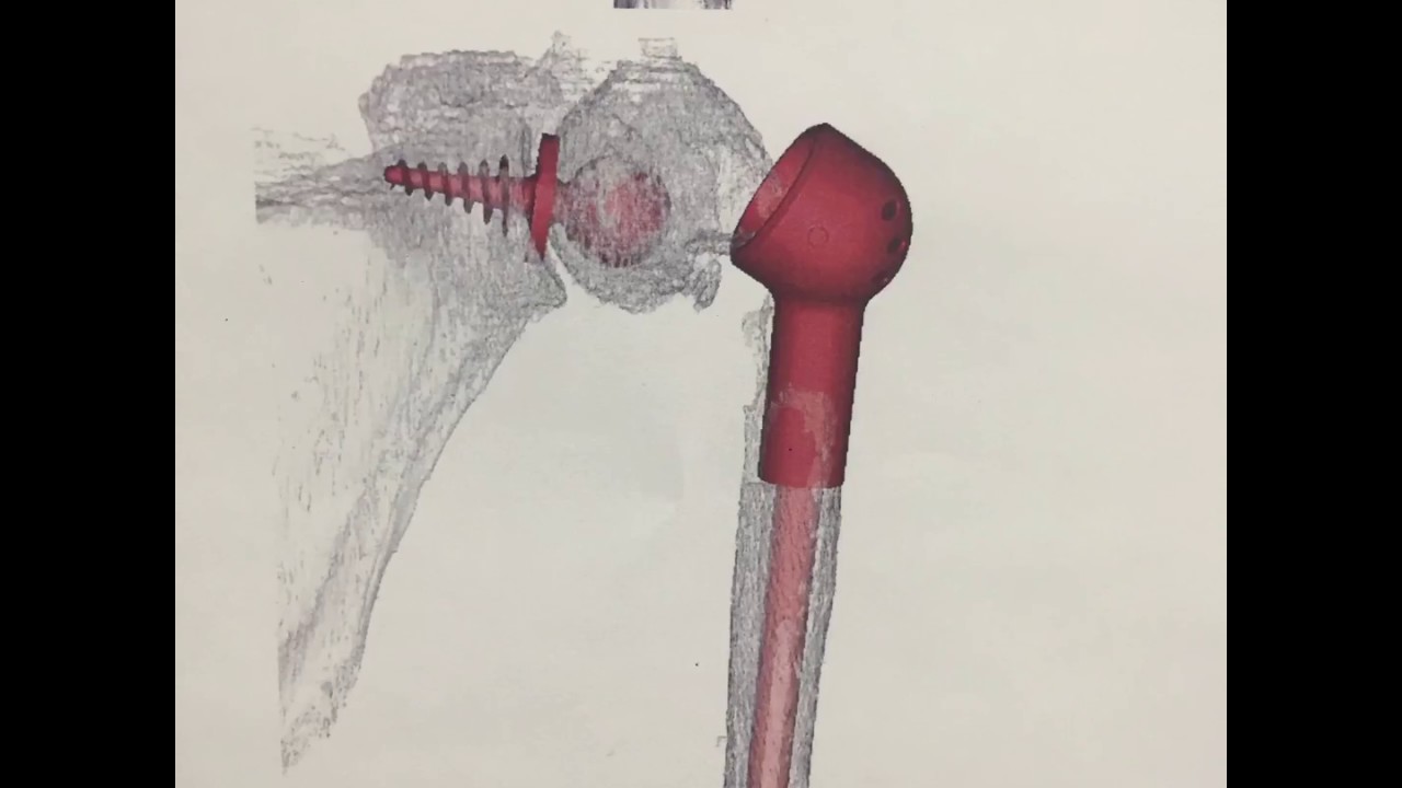 Proximal Humerus replacment with Reverse/Inverse shoulder arthroplasty ...