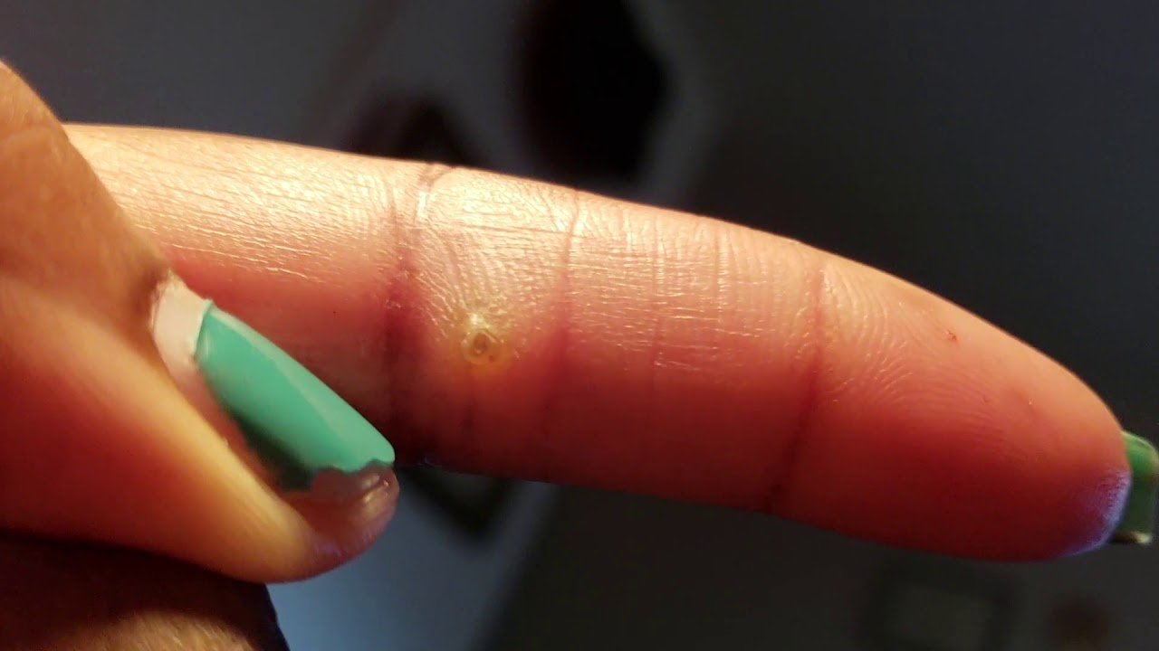 Reaccurring thing on my finger! (Part 1) - YouTube
