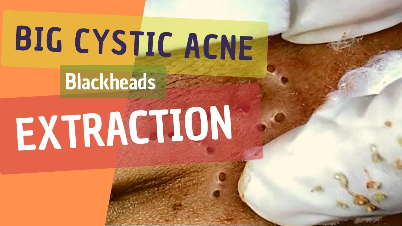 Big Cystic Acne And Blackheads Extraction Youtube