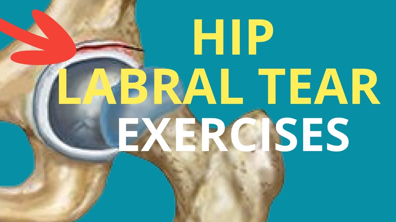 5 Advanced Hip Labral Tear Exercises - YouTube