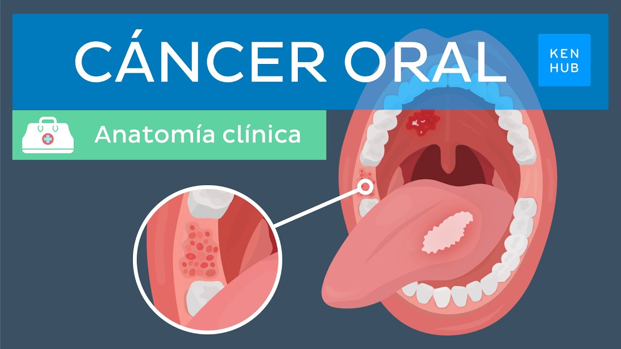 Cáncer oral: Definición, factores de riesgo, prevención, diagnóstico y tratamiento | Kenhub ...