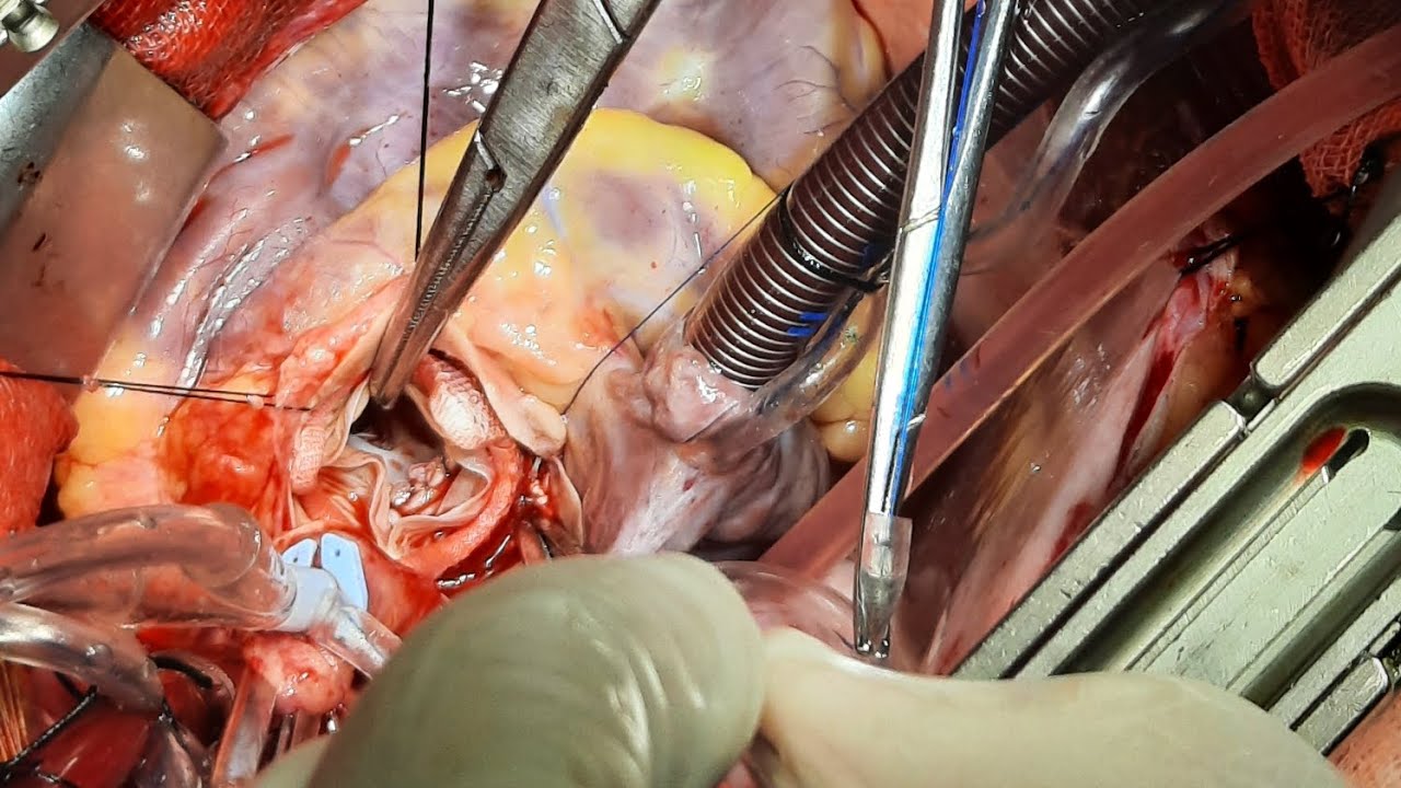 "Y" incision aortic root enlargement with AVR....17 years young lady ...