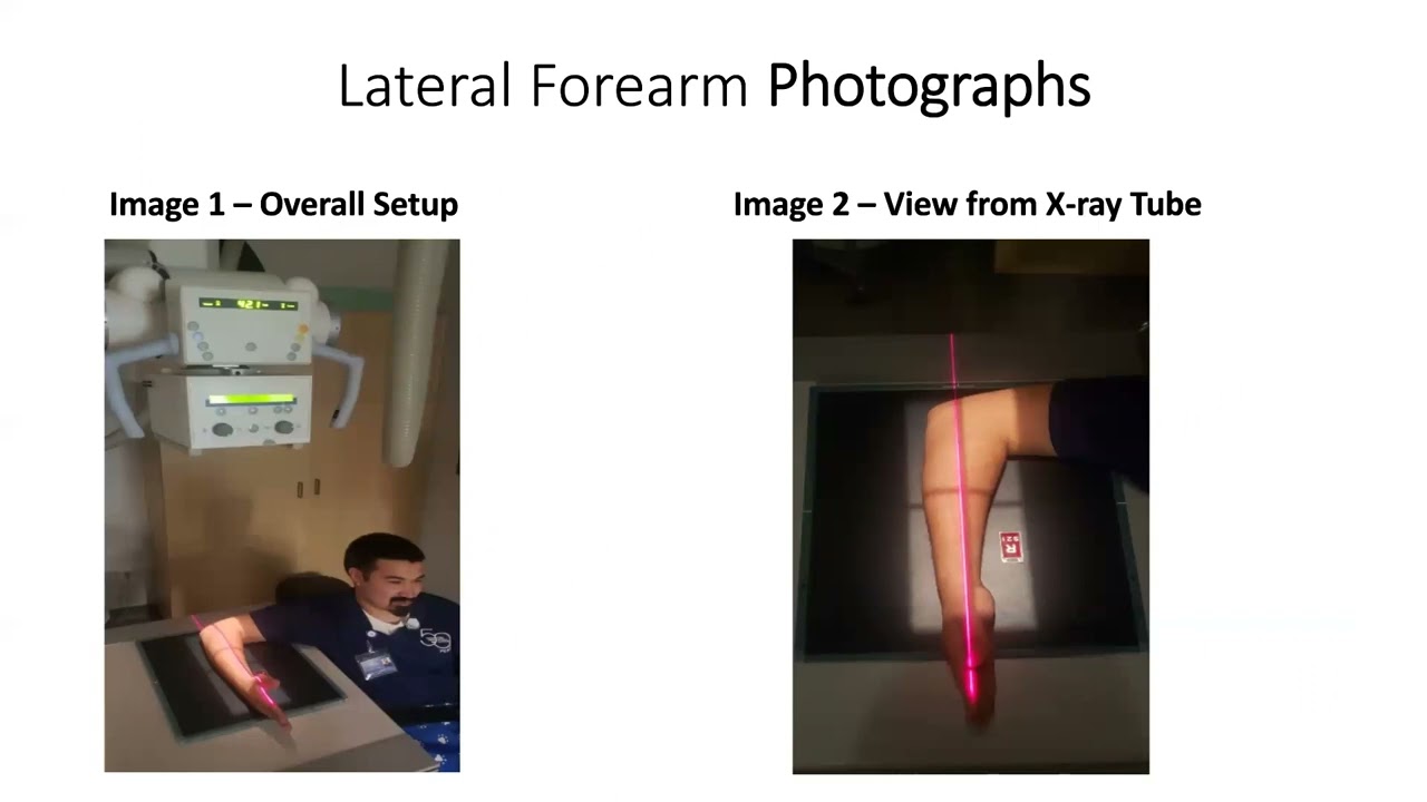 Lateral Forearm Positioning Project - YouTube