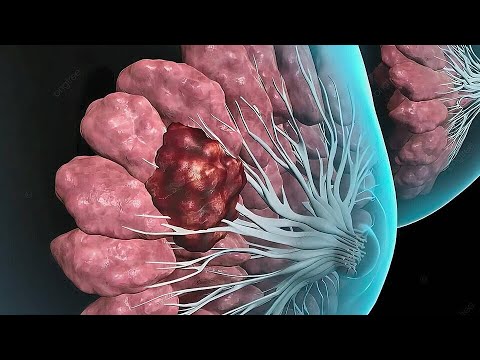 1. ILLUSTRATIVE LECTURE OF THE BREAST - YouTube
