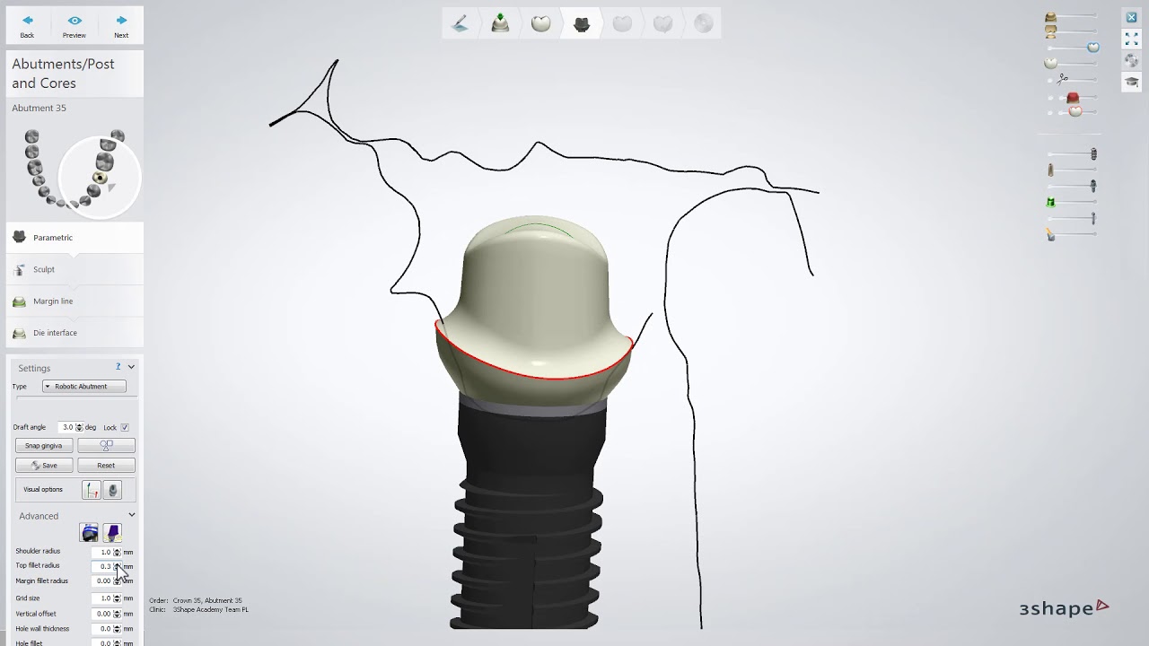 3Shape 덴탈시스템 - 어버트먼트 및 크라운 디자인 - 3Shape Dental System - Abutment and ...