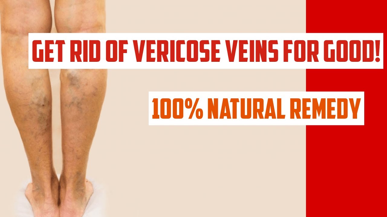 "Unlocking the Power of Lemon: Herbal Remedies for Varicose Veins ...