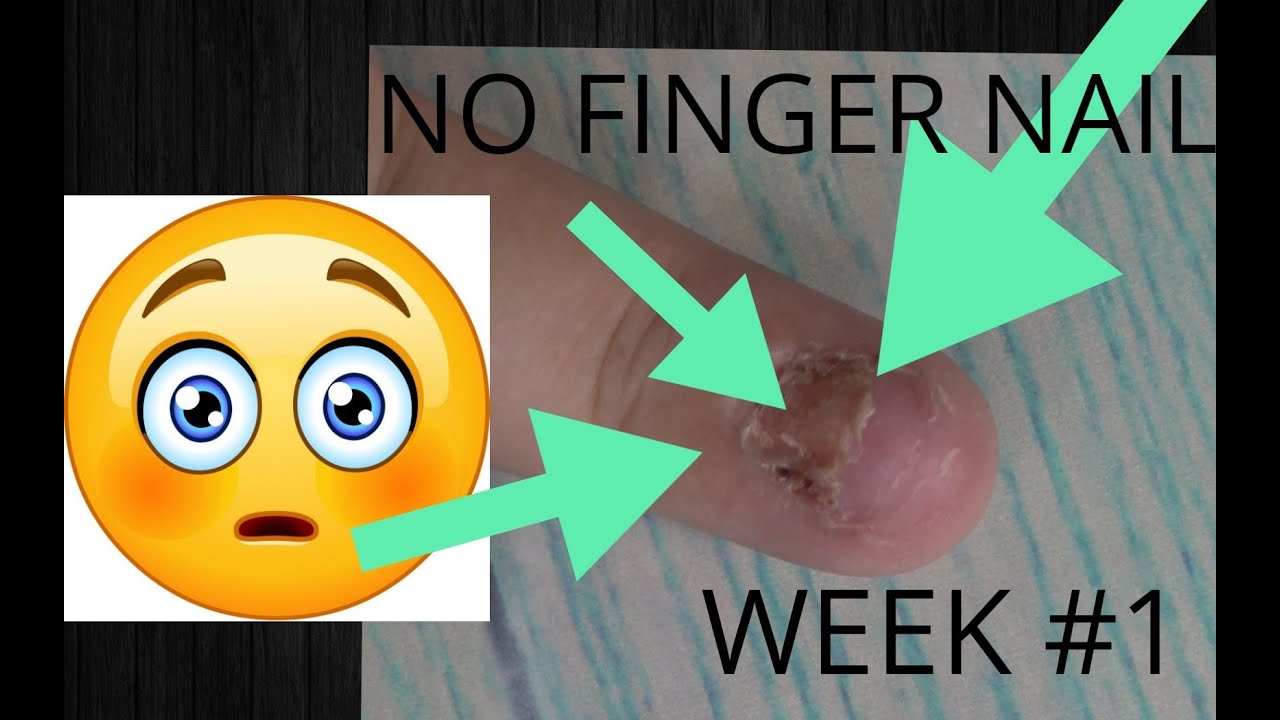 GoodBye FingerNail!! How I lost My Nail Week #1 - YouTube