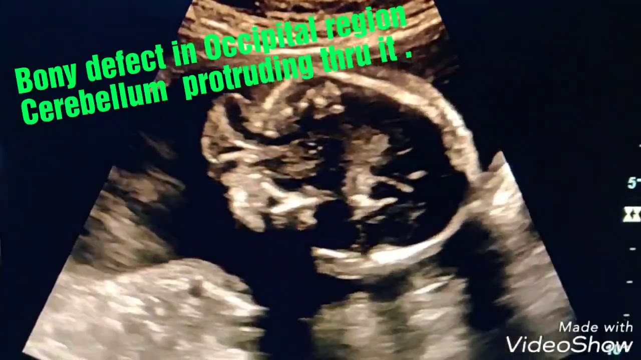 Lemon sign and Banana Sign on ultrasound - YouTube