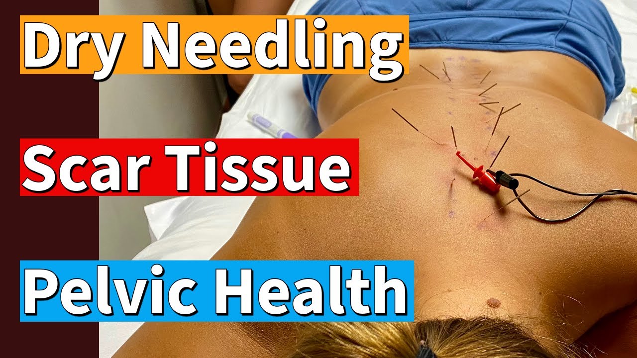 Dry Needling, Scar Tissue, & How to Improve Pelvic Health - YouTube