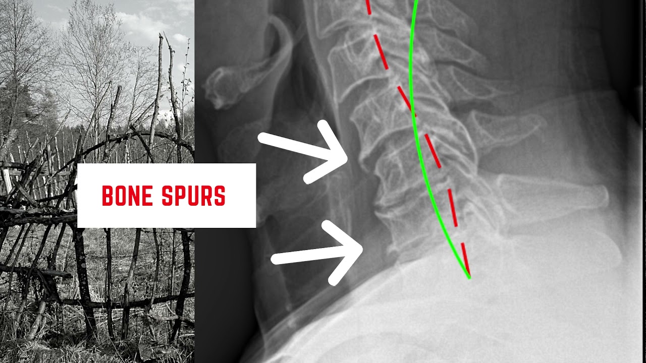 Scary X Rays - YouTube