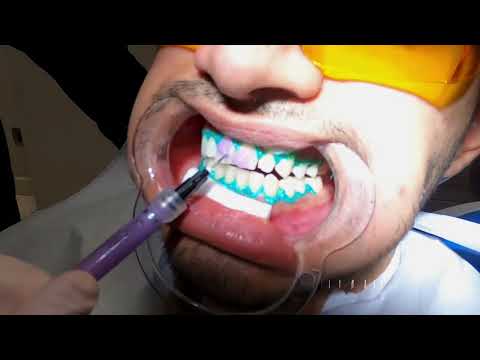 Lazer diş beyazlatma nasıl yapılır? Öncesi sonrası