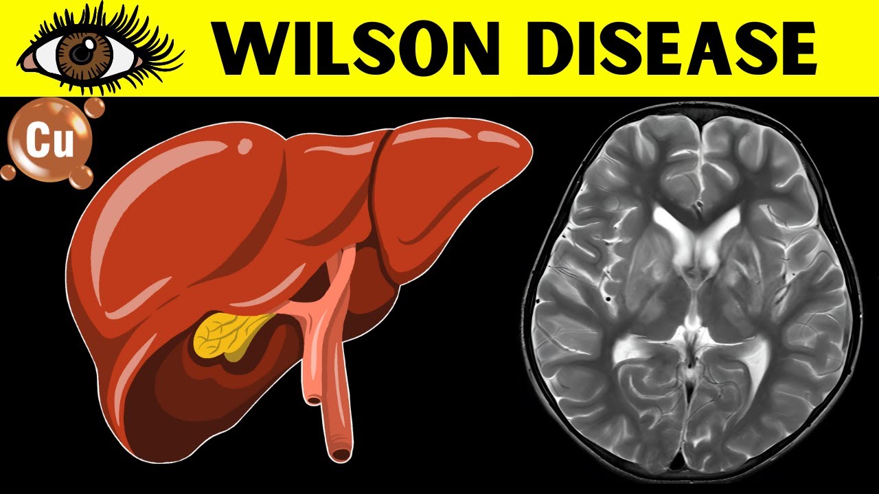 Wilson Disease - The Inherited Disorder Of Copper Metabolism ...