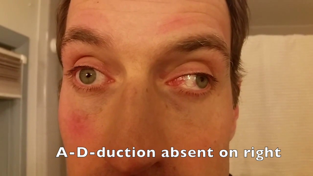 Reel-Example: Internuclear Ophthalmoplegia (MLF lesion on right) - YouTube