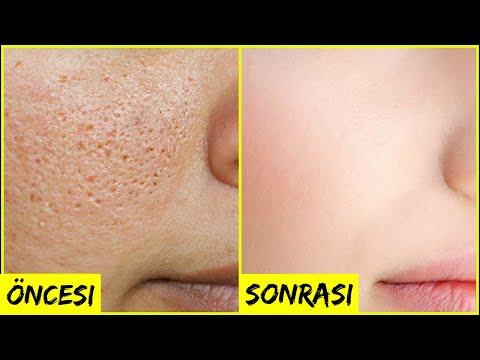 Geniş Gözeneklere Kalıcı Çözüm! Gözenek Sıkılaştırıcı 2 Maske Tarifi