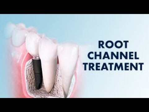 Root chanel treatment. The new era of CADCAM, the intraoral scanners ...