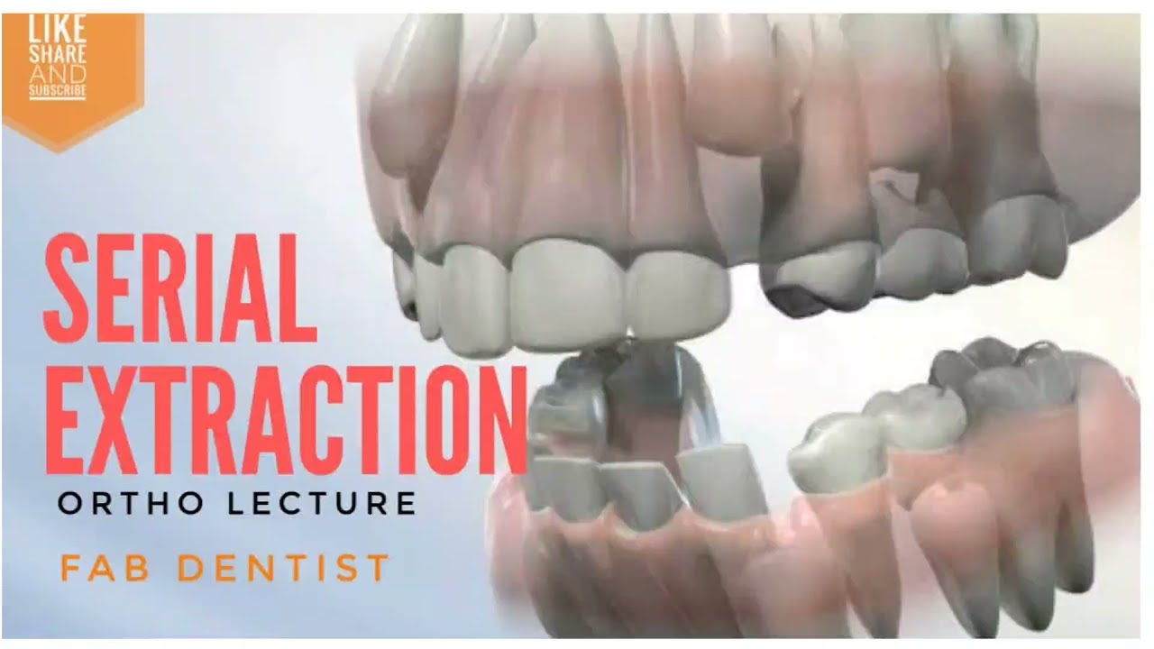 SERIAL EXTRACTION//ORTHODONTIC SERIES - YouTube