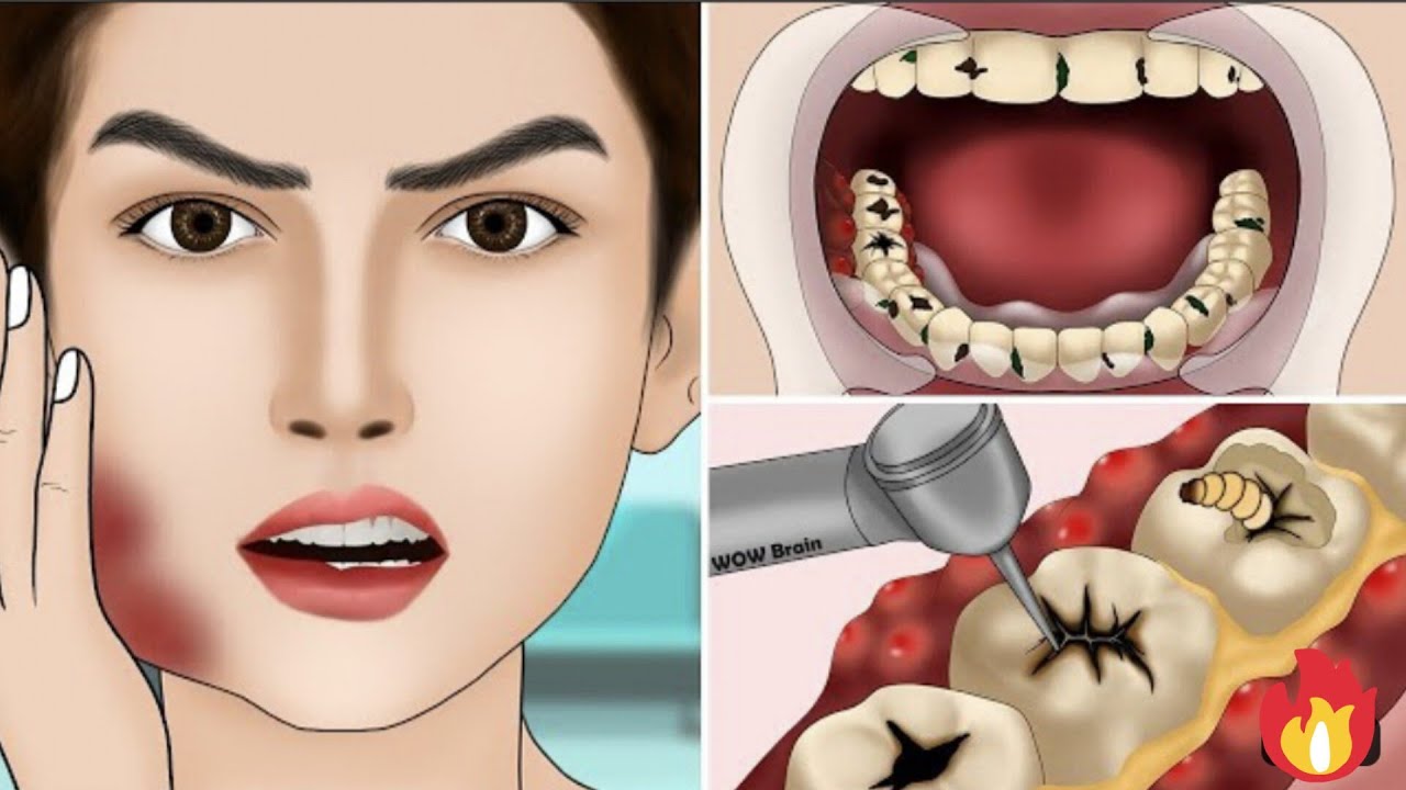 Very Heavy Tartar Removal Animation | Calculus Cleaning | Dental ...