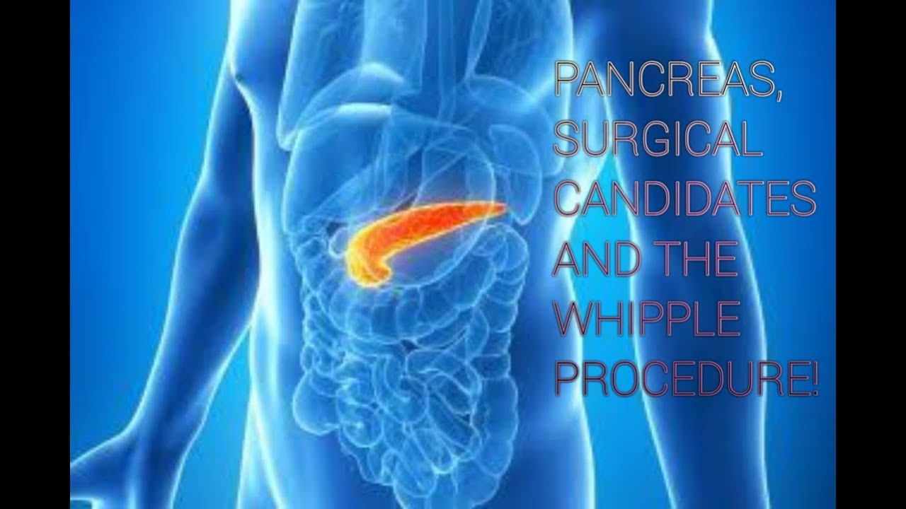 Pancreas, Surgical candidates and The Whipple procedure - YouTube