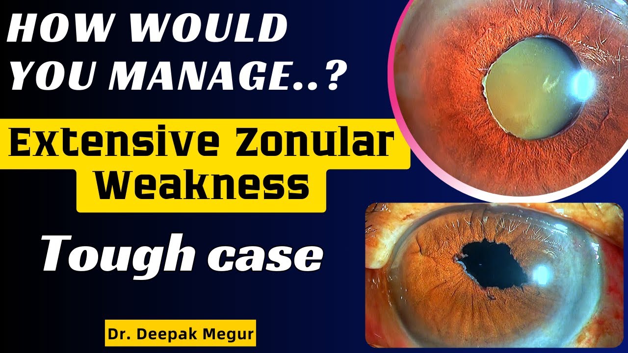 A tough case.The thought process.Dense Cataract,Extreme Zonular ...