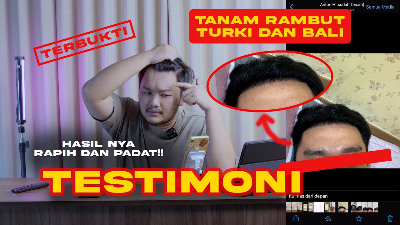 TESTIMONI TANAM RAMBUT DI TURKI DAN BALI !! | HAIRTRANSPLANT TURKEY ...