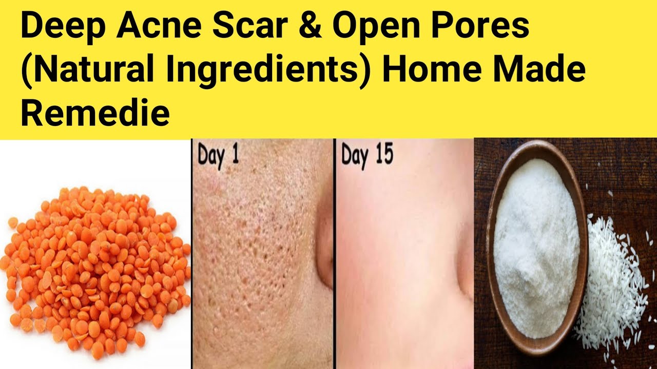 Deep Acne Scar, Open Pores (Natural Ingredients) Home Made Remedie..All ...