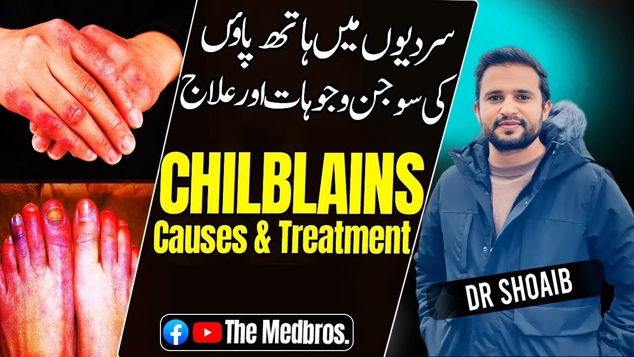 CHILBLAINS | Sardiyun Mein Hath Paon Ki Swelling - YouTube