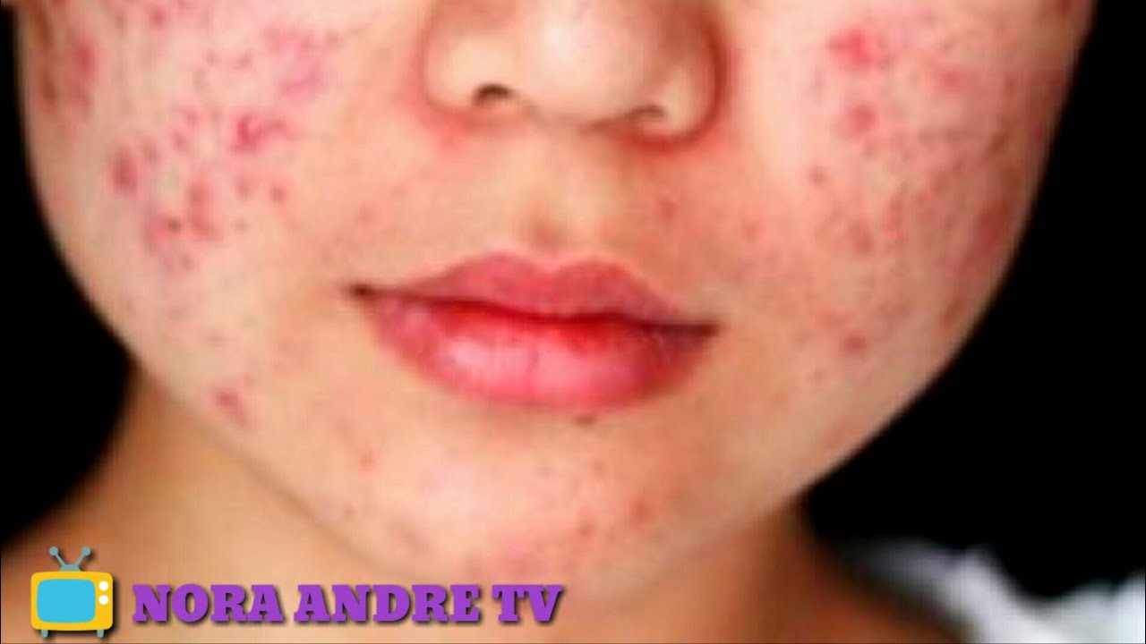 Blackhead Remove clean Pimples Above The Lips rimuovere Il Comedone blackhead-remove-clean-pimples-above-the-lips-rimuovere-il-comedone