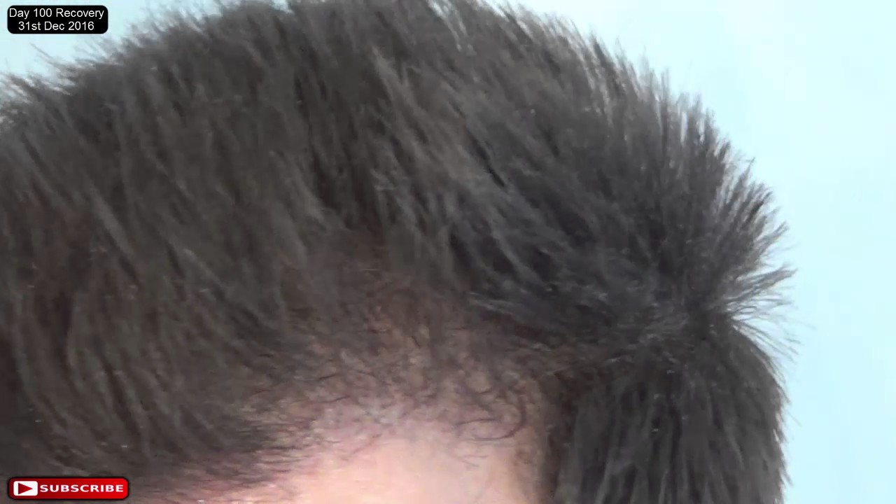 FUE Hair Transplant: Day 100 Post Op Recovery - YouTube