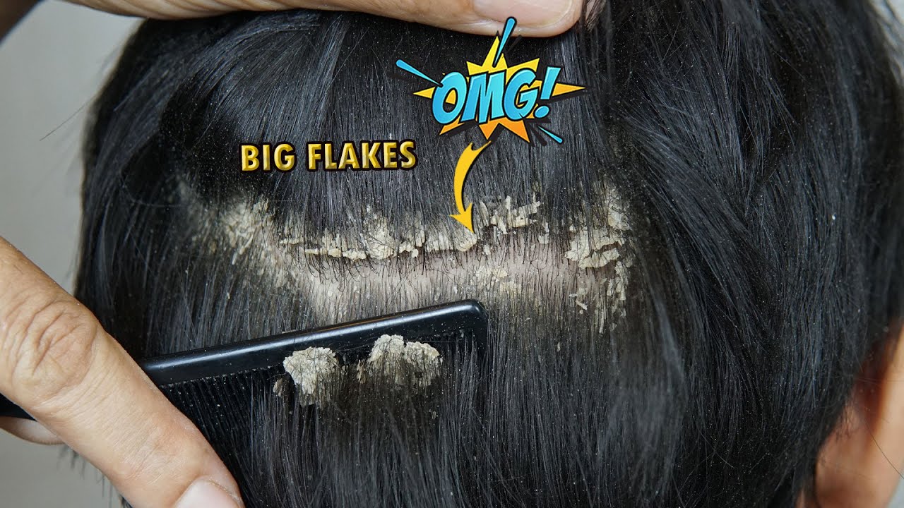 Combing And Scratching Dandruff Off Scalp 1174 Youtube